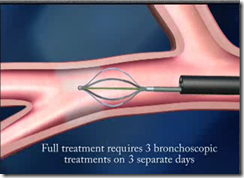 Severe Asthma Relief without drugs – Bronchial Thermoplasty - Medical Quack